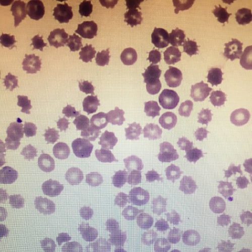 What’s causing this teenager’s vision loss? - AMSA